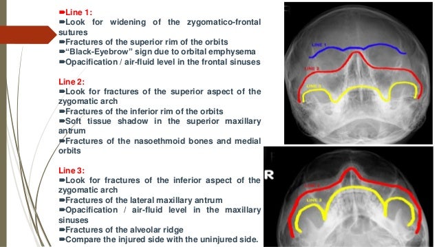 How To Read Facial Bone X-Rays By Peter Andre Soltau -Jan2015