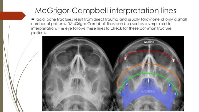 How To Read Facial Bone X-Rays By Peter Andre Soltau -Jan2015
