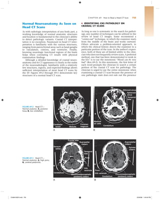 Head CT | PDF