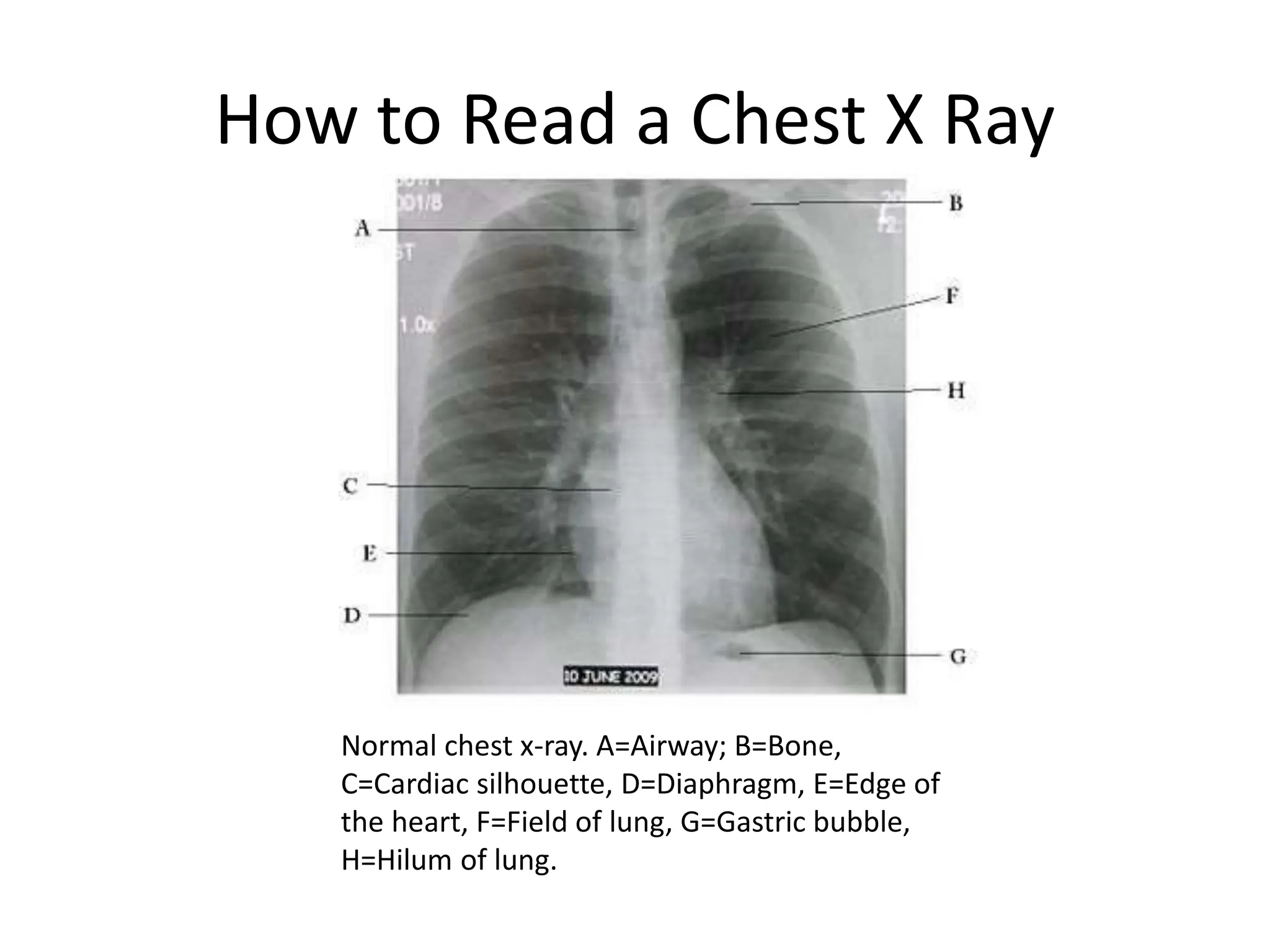 Bagaimana cara membaca foto rontgen/x-ray | PPT