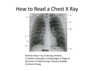 Bagaimana cara membaca foto rontgen/x-ray | PPT