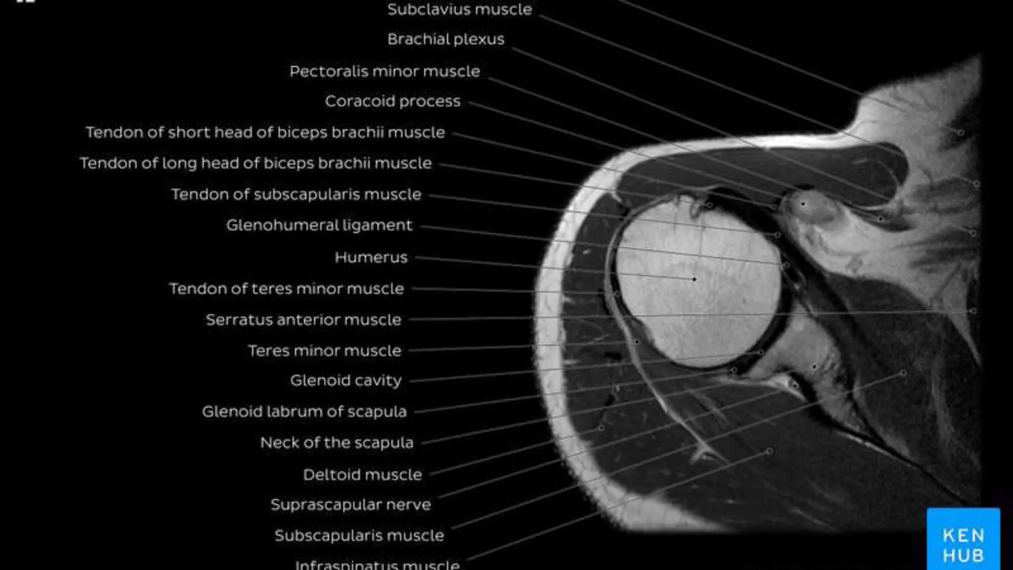 HOW TO READ SHOULDER MRI | PPTX