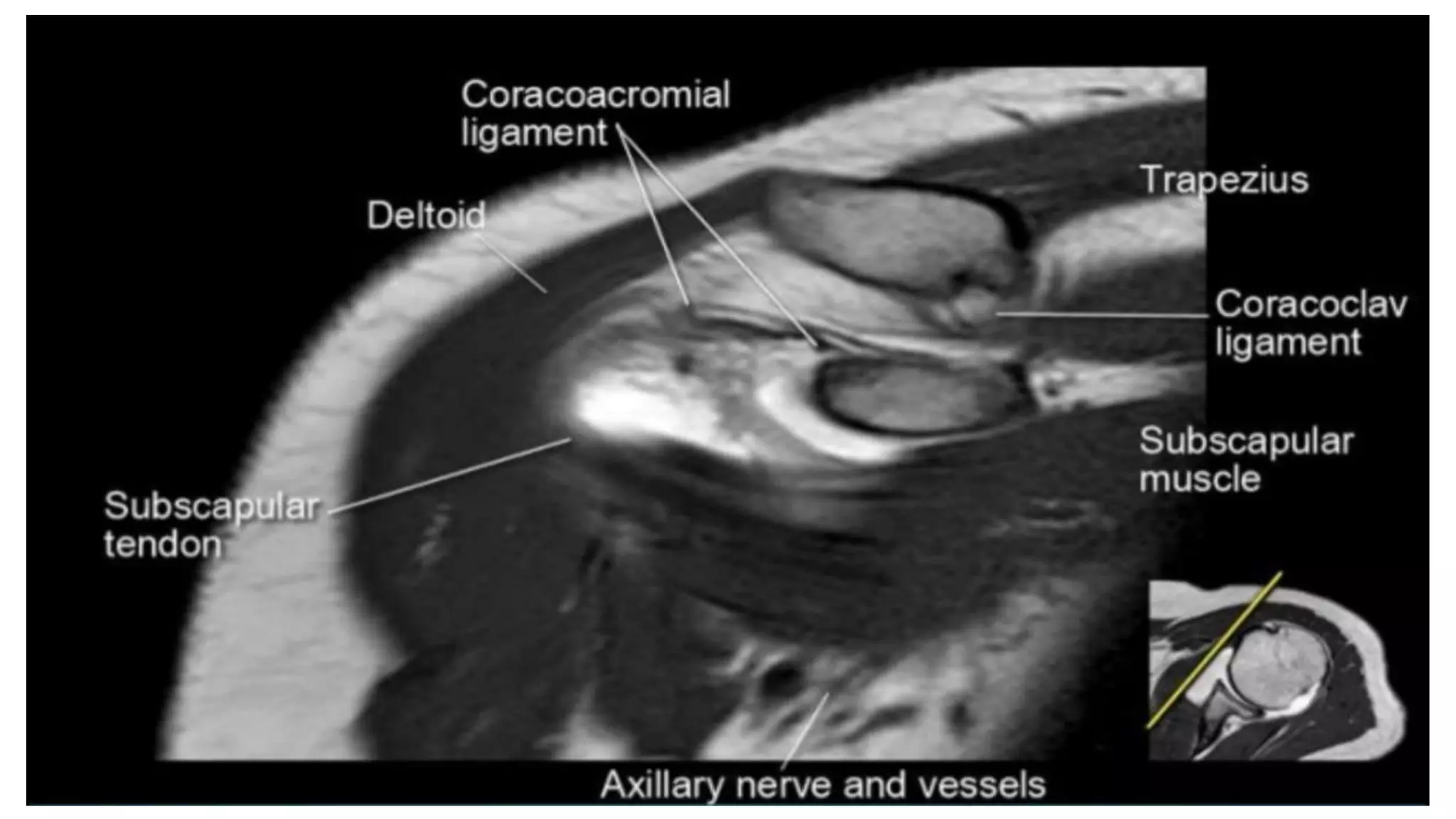 HOW TO READ SHOULDER MRI | PPTX