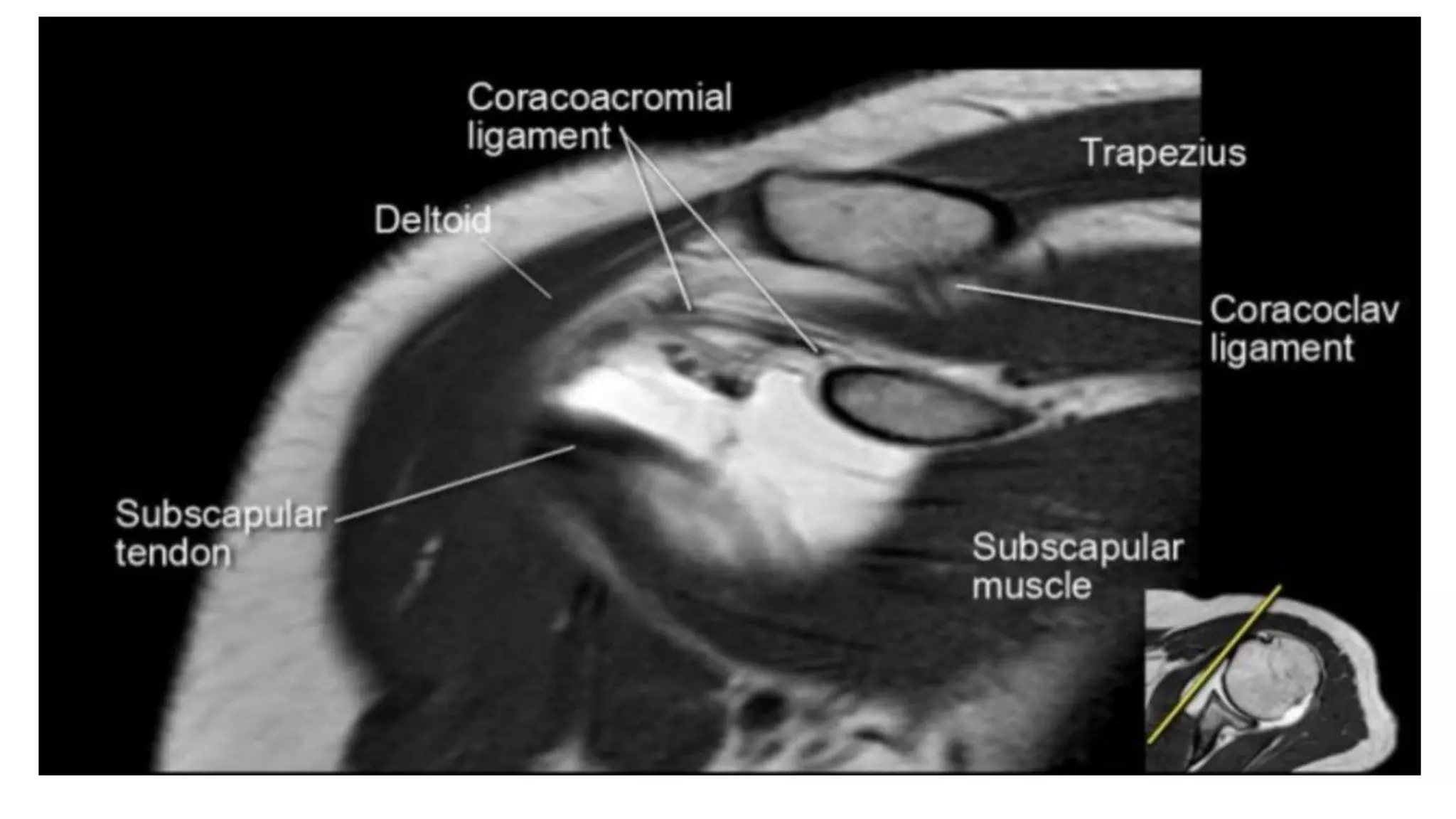 HOW TO READ SHOULDER MRI | PPTX
