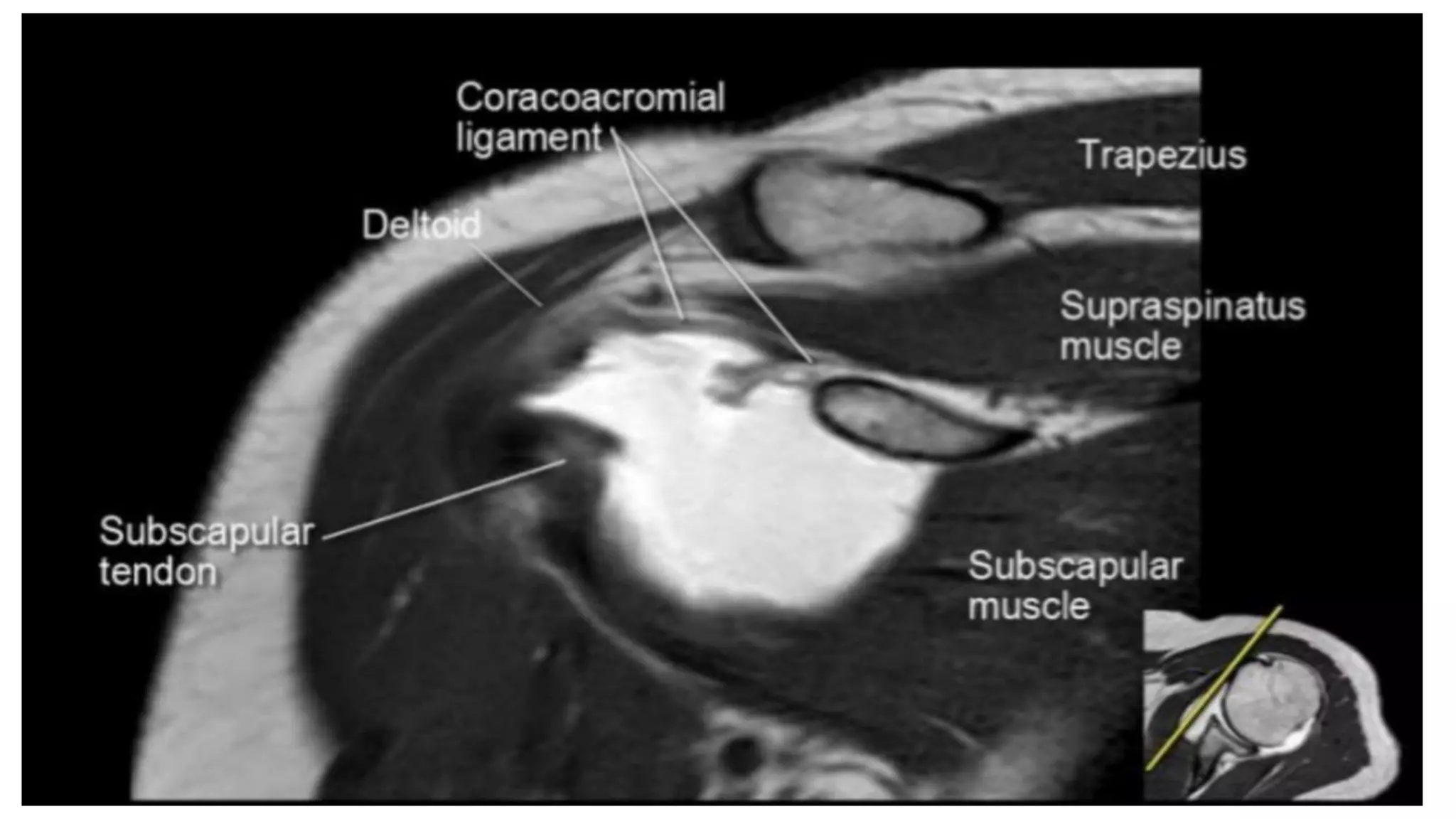 HOW TO READ SHOULDER MRI | PPTX