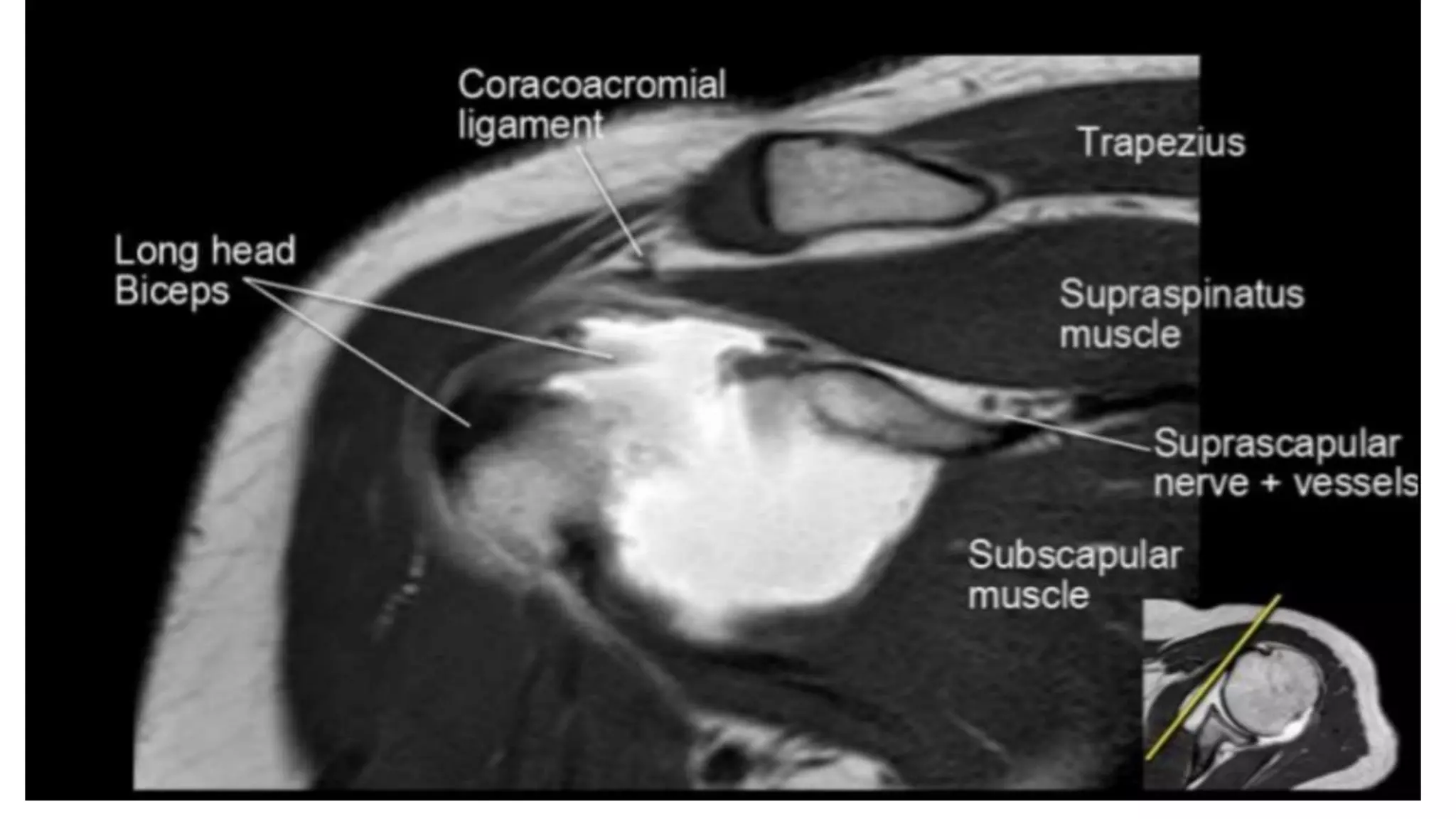 HOW TO READ SHOULDER MRI | PPTX