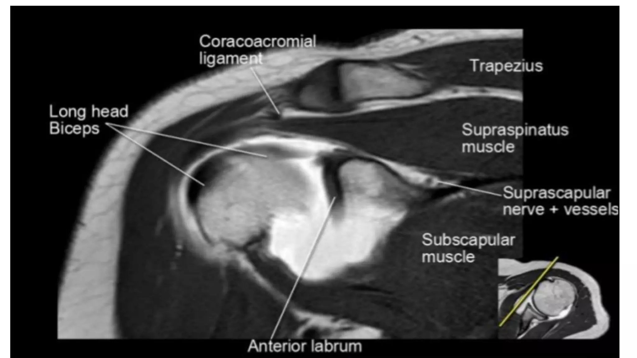 HOW TO READ SHOULDER MRI | PPTX