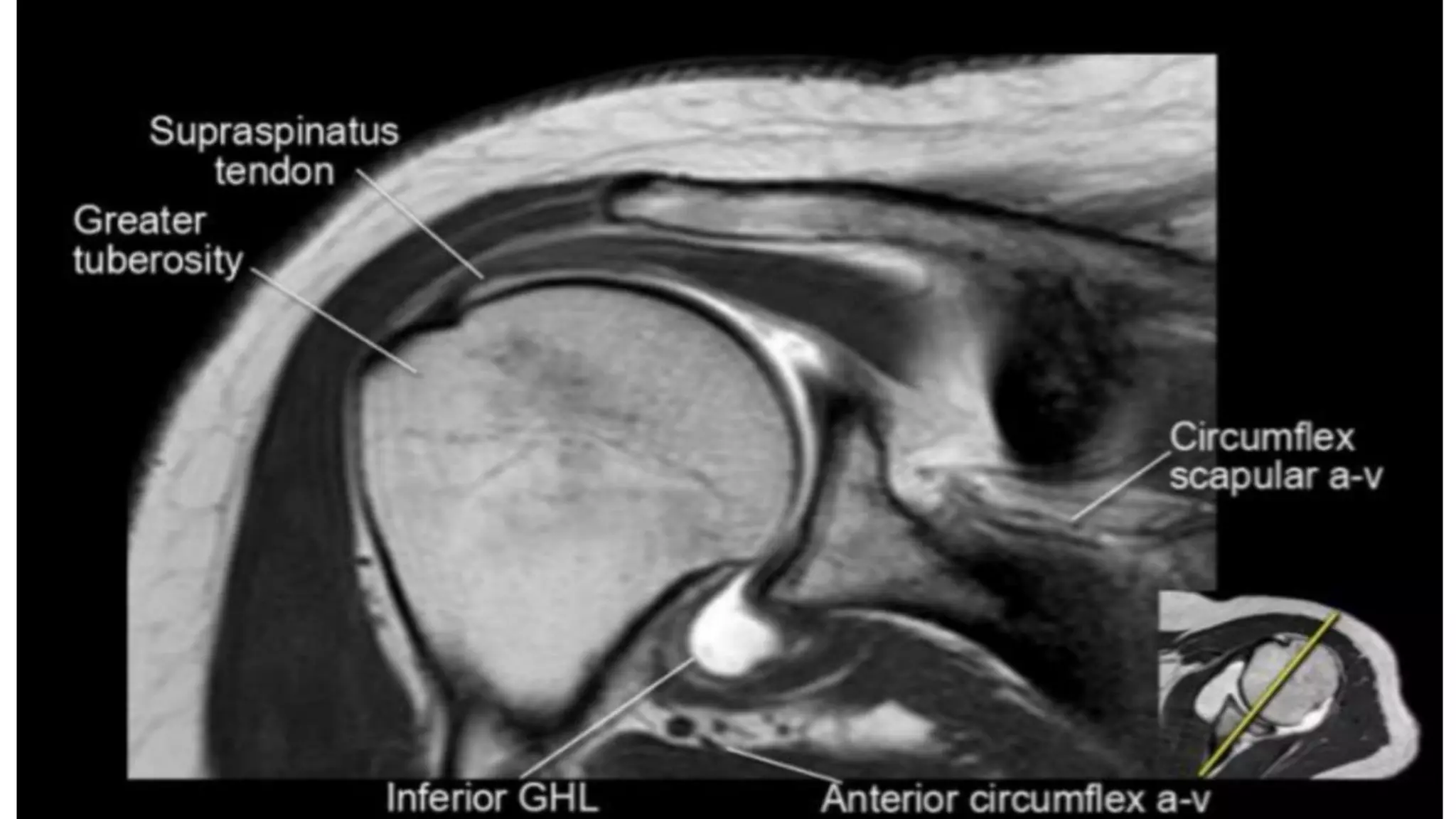 HOW TO READ SHOULDER MRI | PPTX