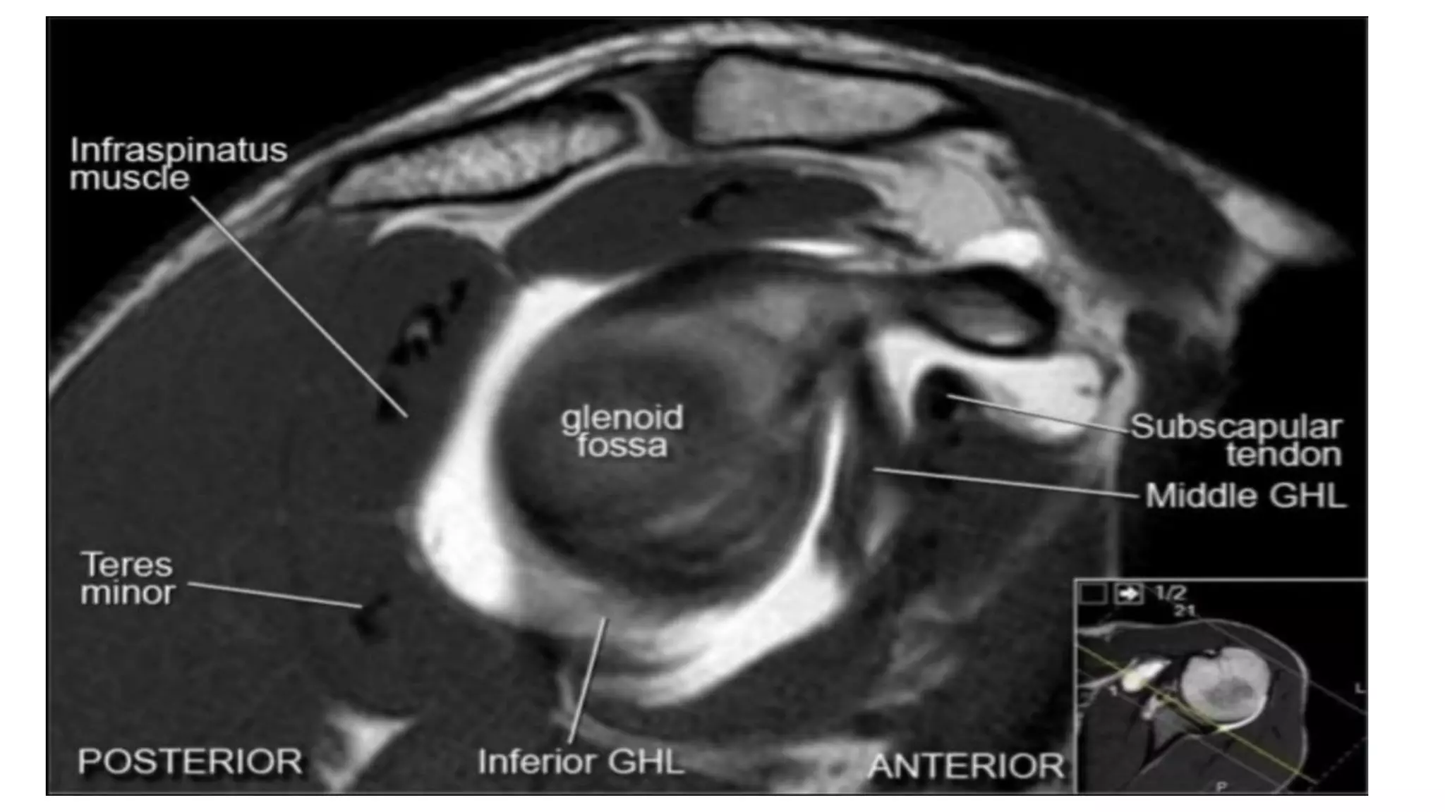 HOW TO READ SHOULDER MRI | PPTX