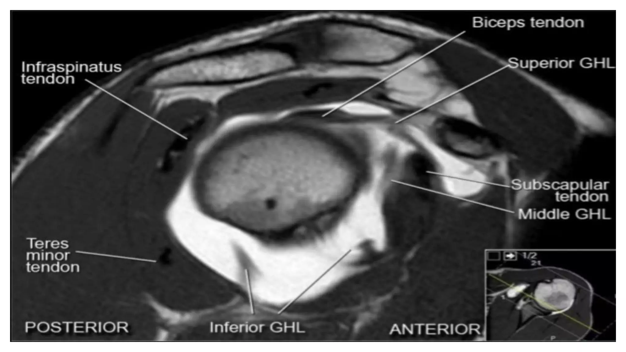 HOW TO READ SHOULDER MRI | PPTX
