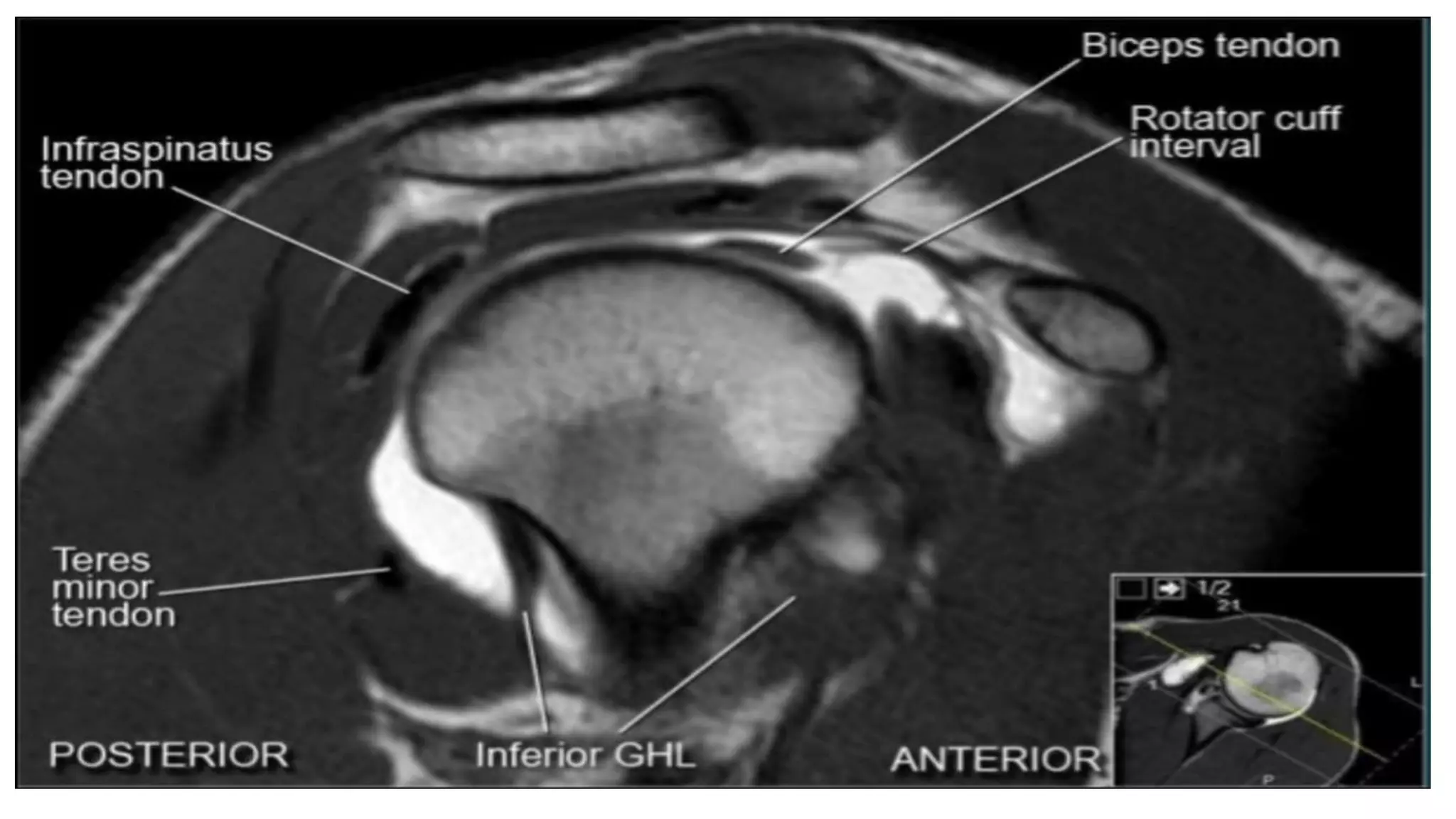 HOW TO READ SHOULDER MRI | PPTX