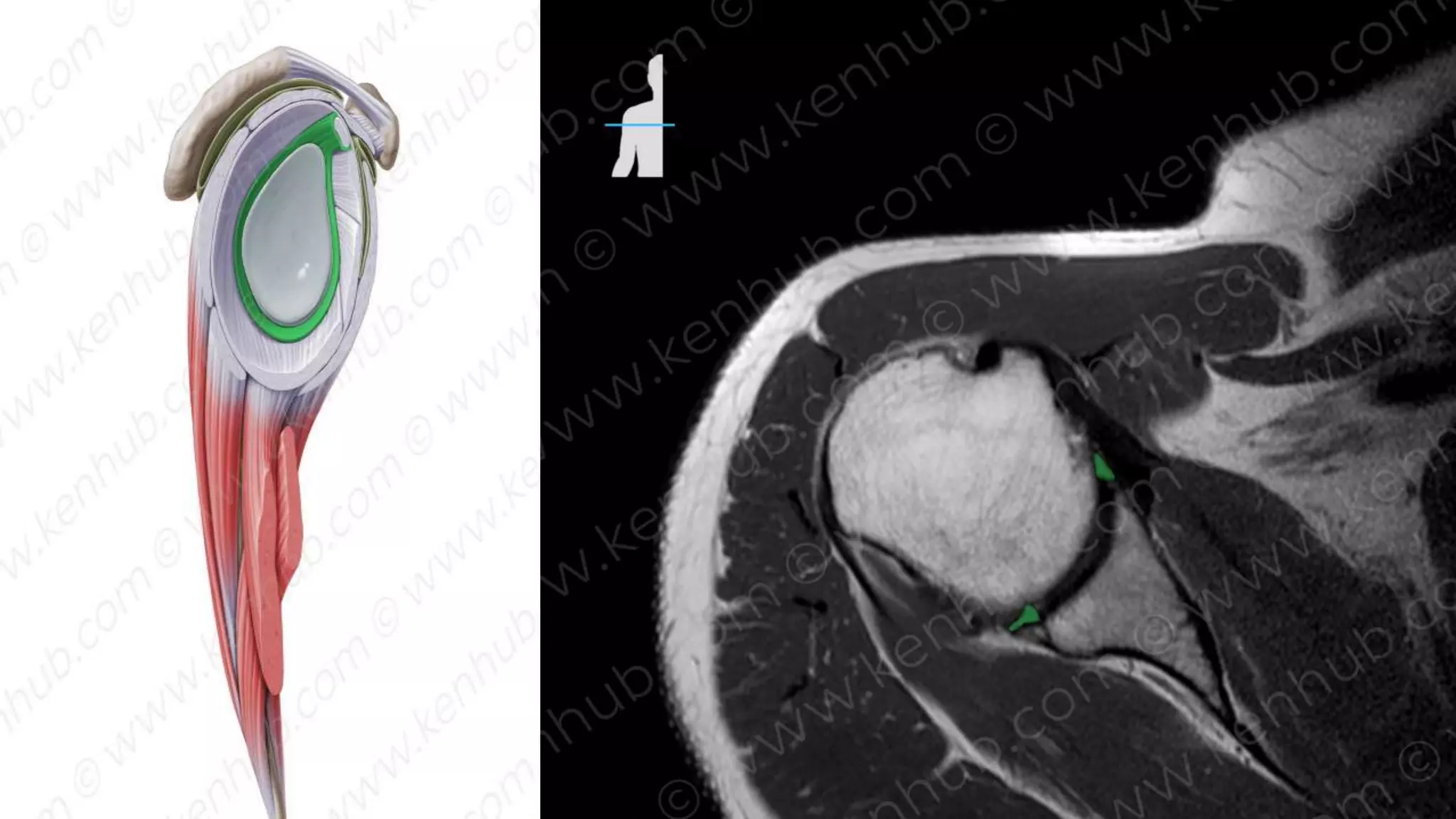 HOW TO READ SHOULDER MRI | PPTX