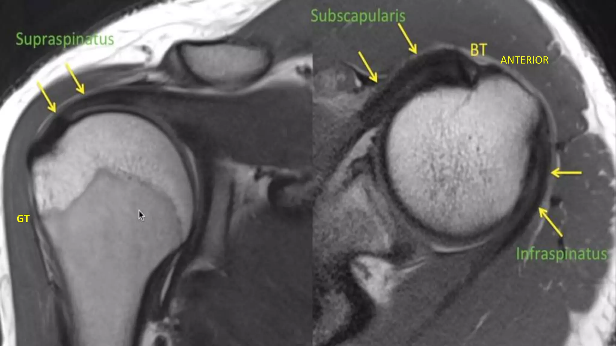 HOW TO READ SHOULDER MRI | PPTX