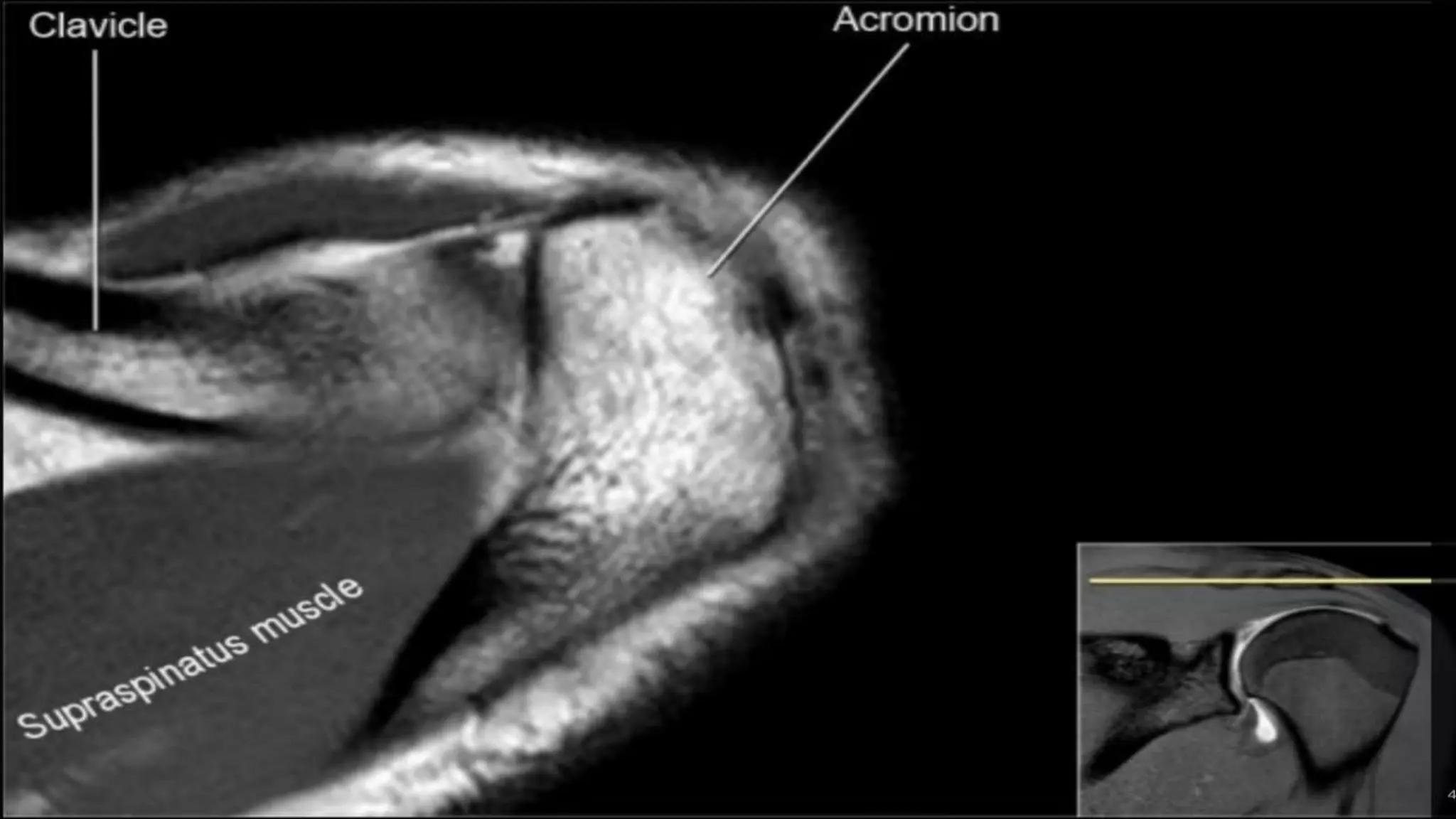 HOW TO READ SHOULDER MRI | PPTX