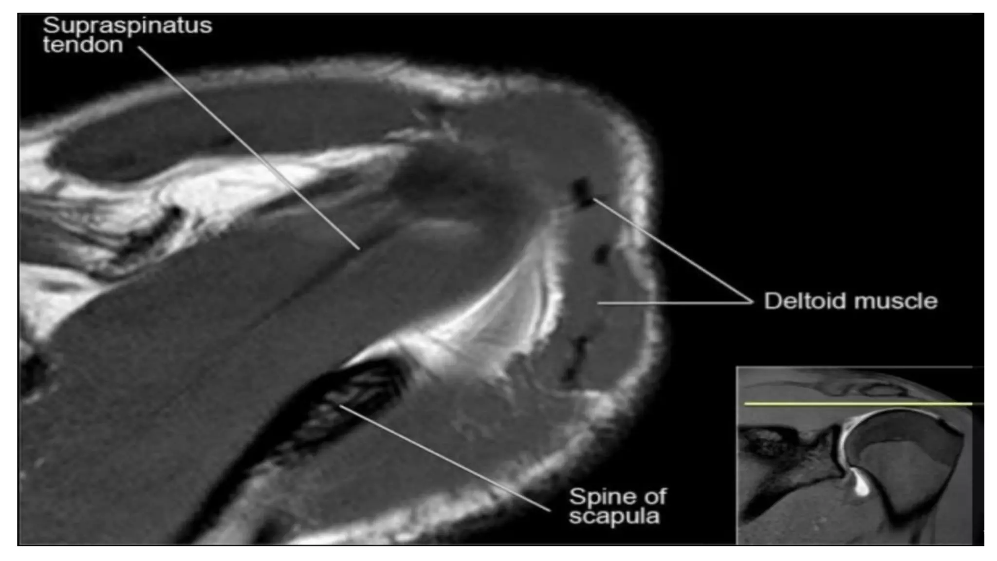 HOW TO READ SHOULDER MRI | PPTX