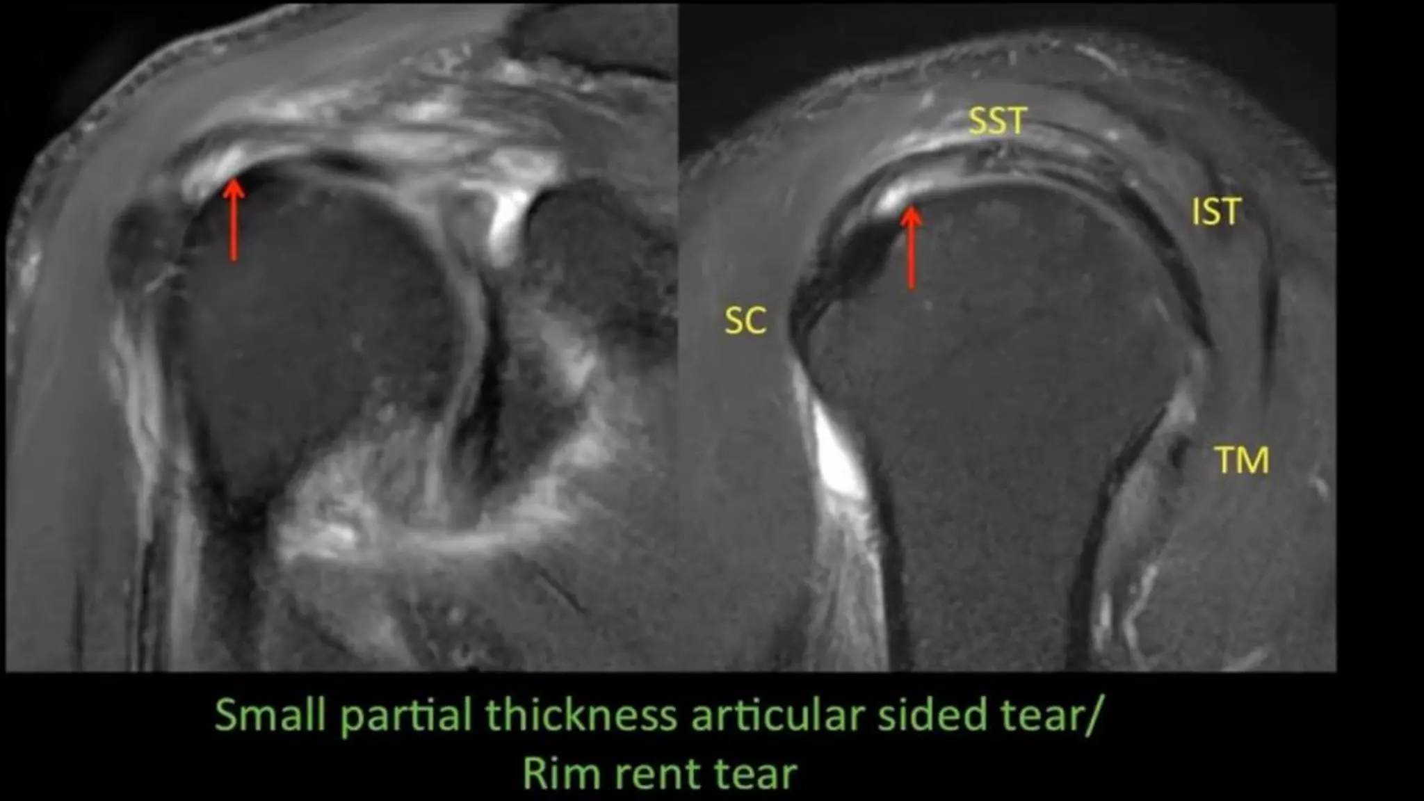 HOW TO READ SHOULDER MRI | PPTX