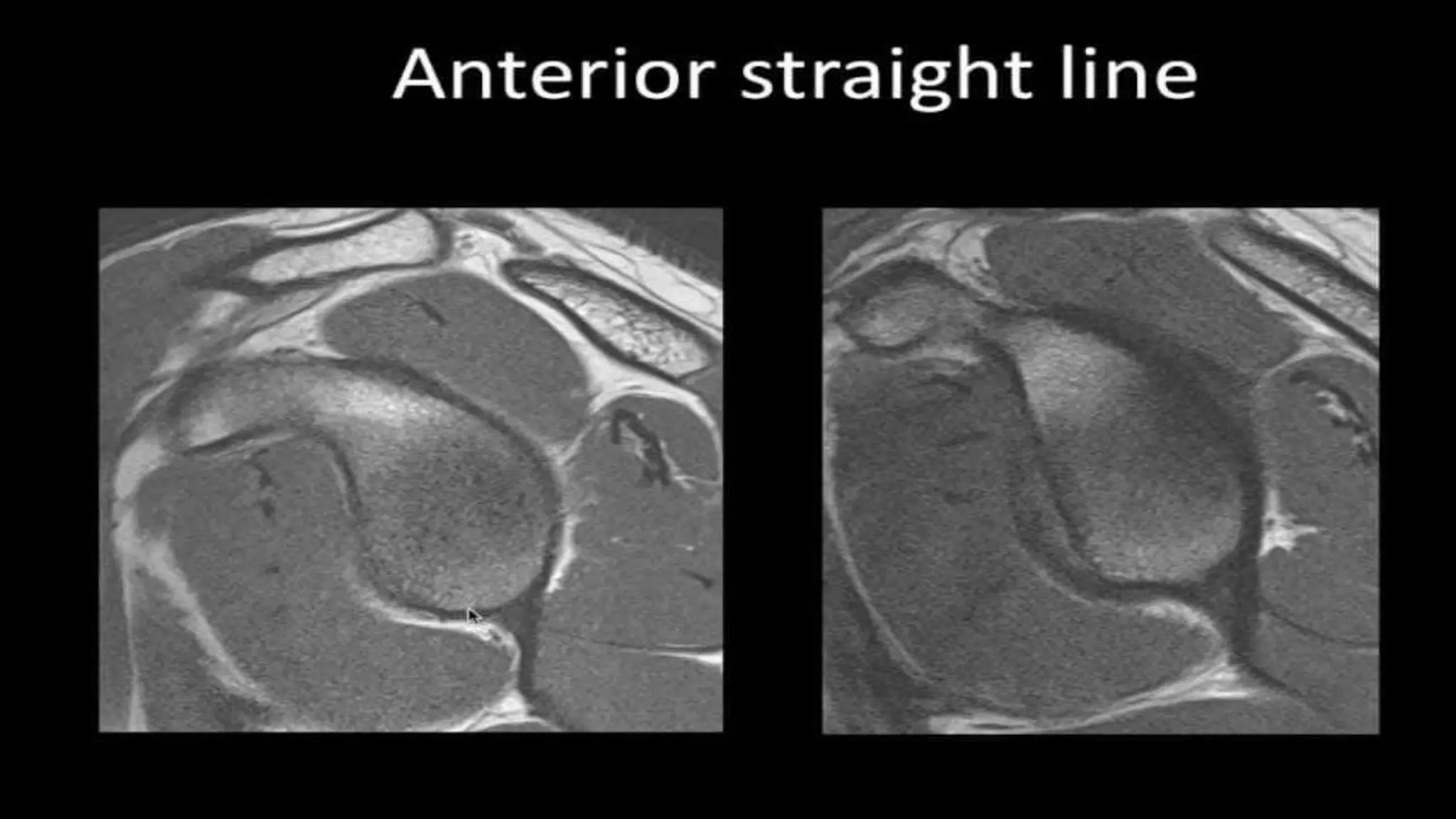 HOW TO READ SHOULDER MRI | PPTX