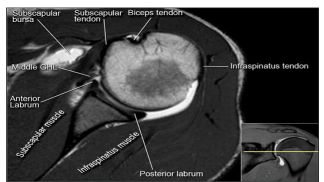HOW TO READ SHOULDER MRI | PPTX | Death, Injury, or Military Conflict ...