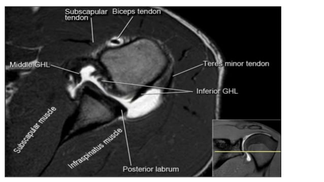 HOW TO READ SHOULDER MRI | PPTX | Death, Injury, or Military Conflict ...