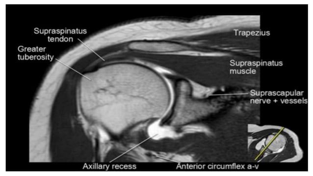 HOW TO READ SHOULDER MRI | PPTX | Death, Injury, or Military Conflict ...