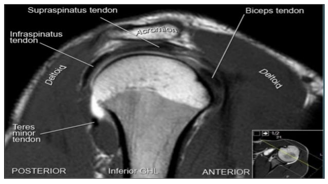 HOW TO READ SHOULDER MRI | PPTX | Death, Injury, or Military Conflict ...