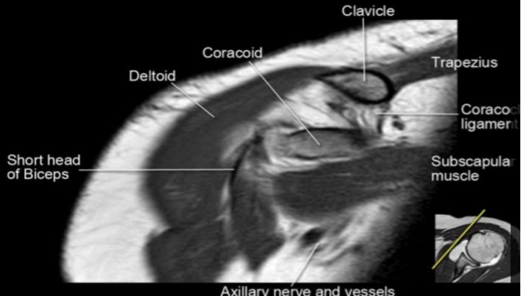 HOW TO READ SHOULDER MRI
