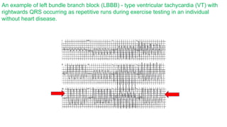 How to recognise and manage idiopathic ventricular tachycardia (nhịp ...