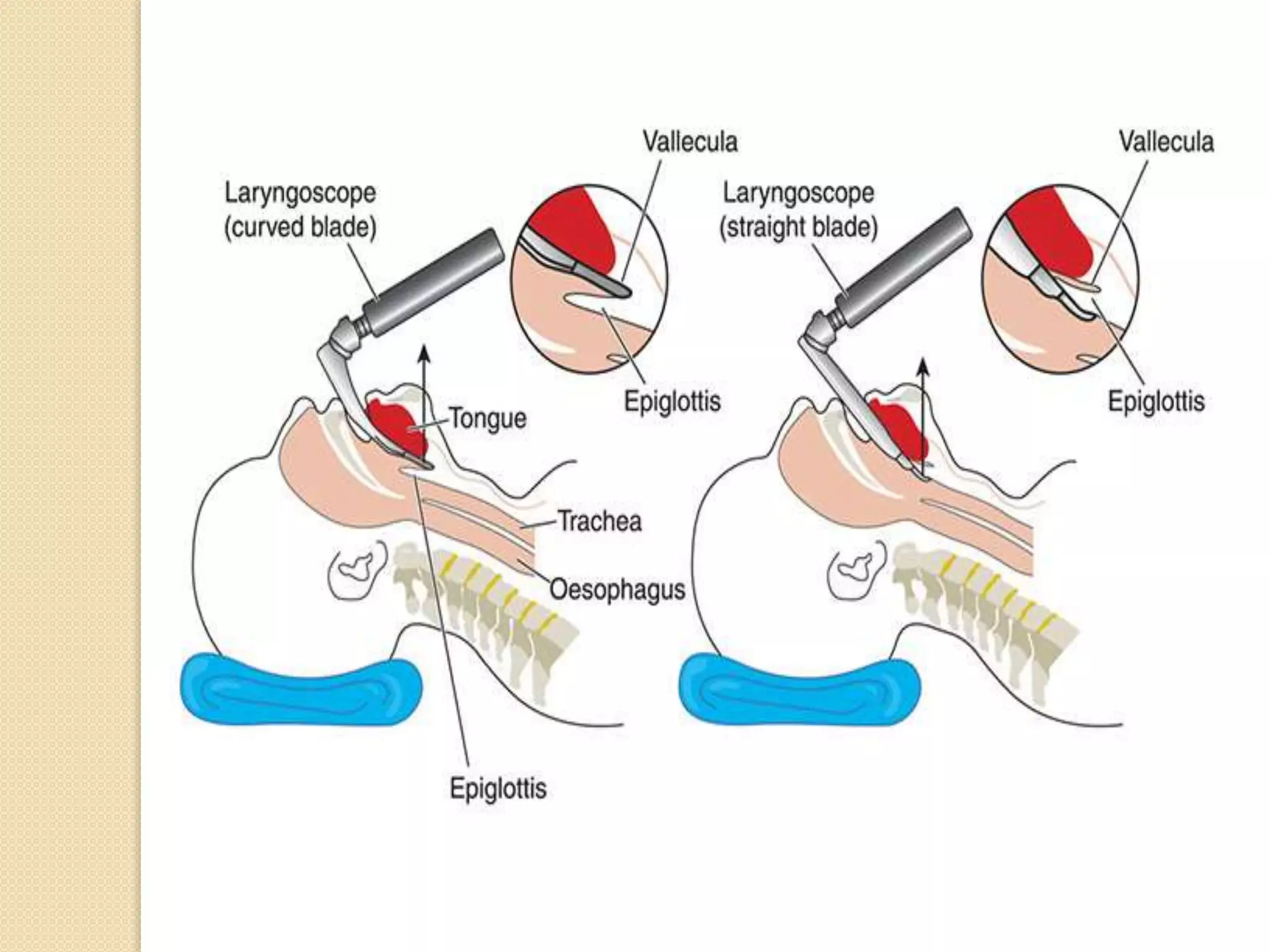 HOW TO SET UP INTUBATION TRAY IN OT-PRACTICAL.pptx