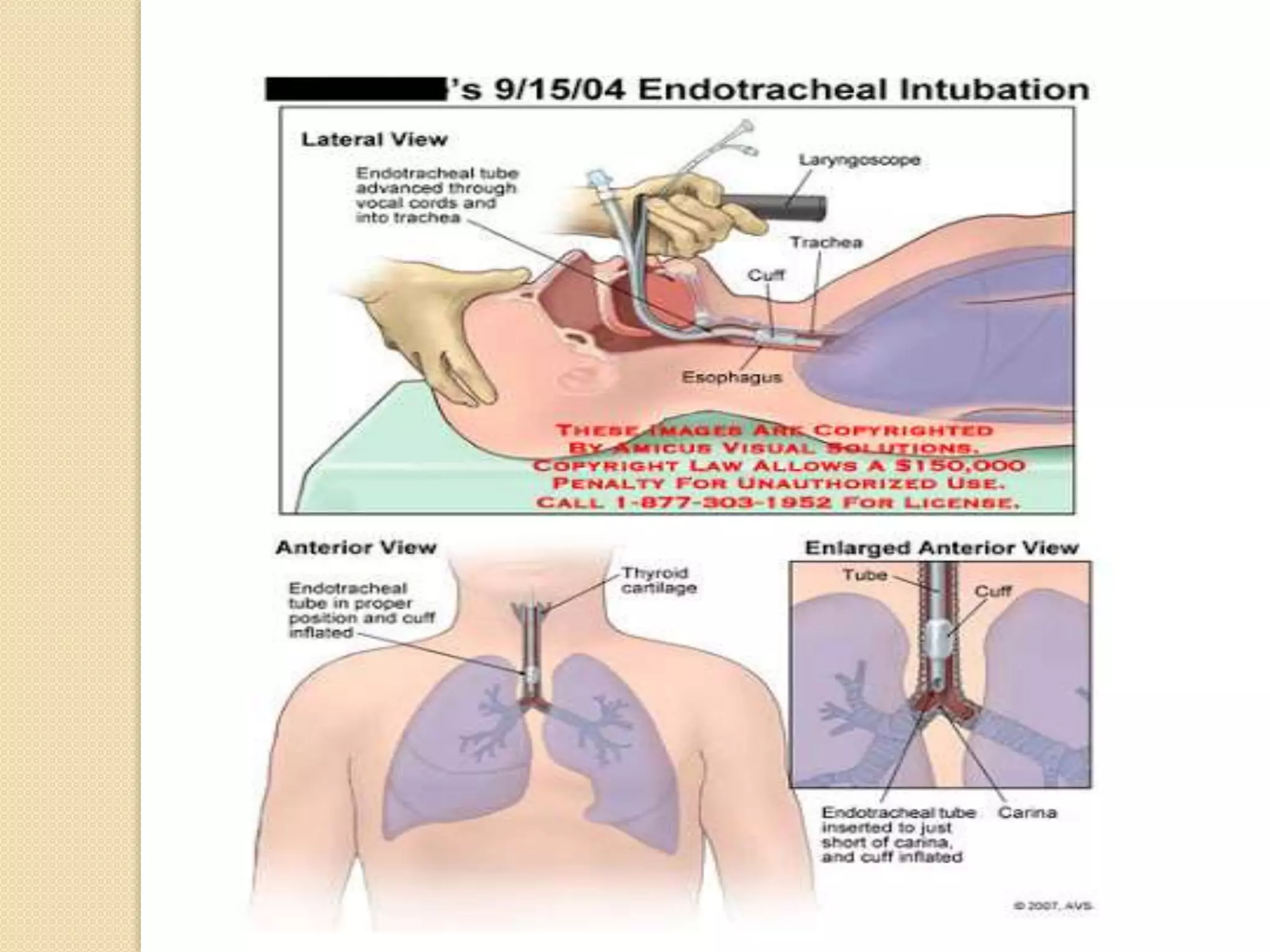 HOW TO SET UP INTUBATION TRAY IN OT-PRACTICAL.pptx