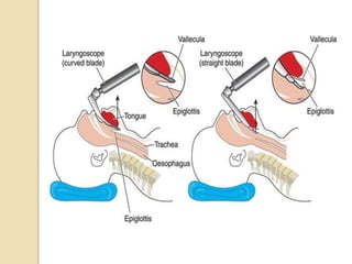 HOW TO SET UP INTUBATION TRAY IN OT-PRACTICAL.pptx