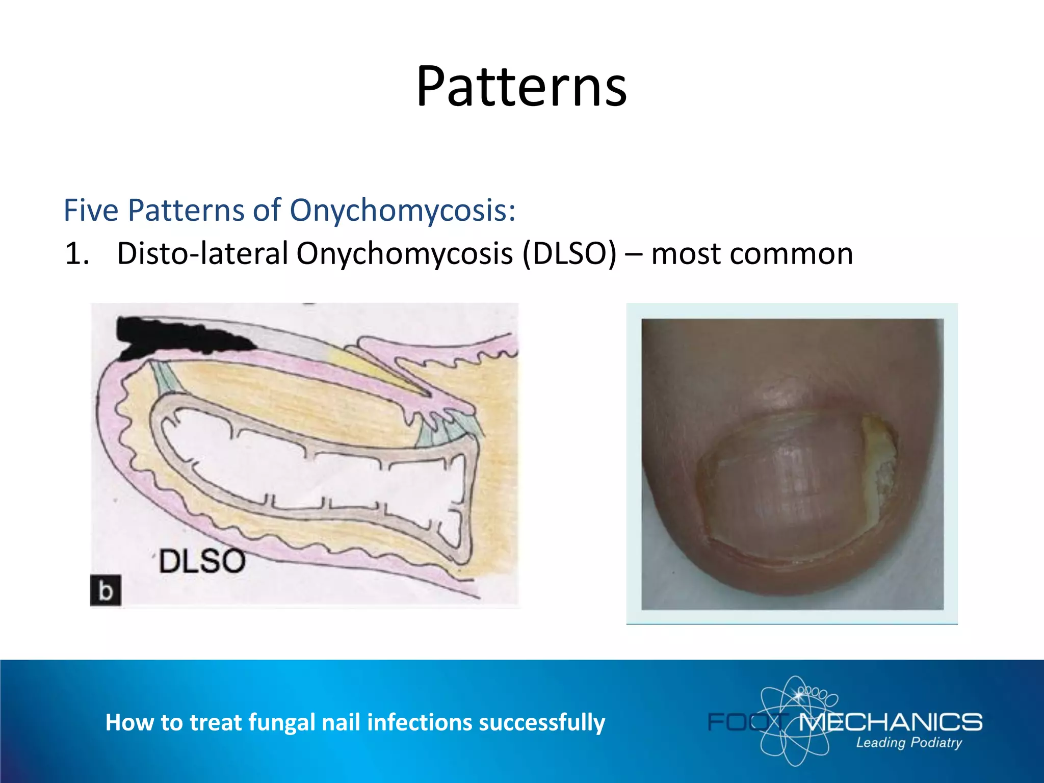 How to successfully treat fungal nail infections - GP Workshop Summary ...