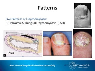 How to successfully treat fungal nail infections - GP Workshop Summary ...
