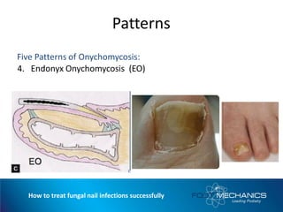 How to successfully treat fungal nail infections - GP Workshop Summary ...