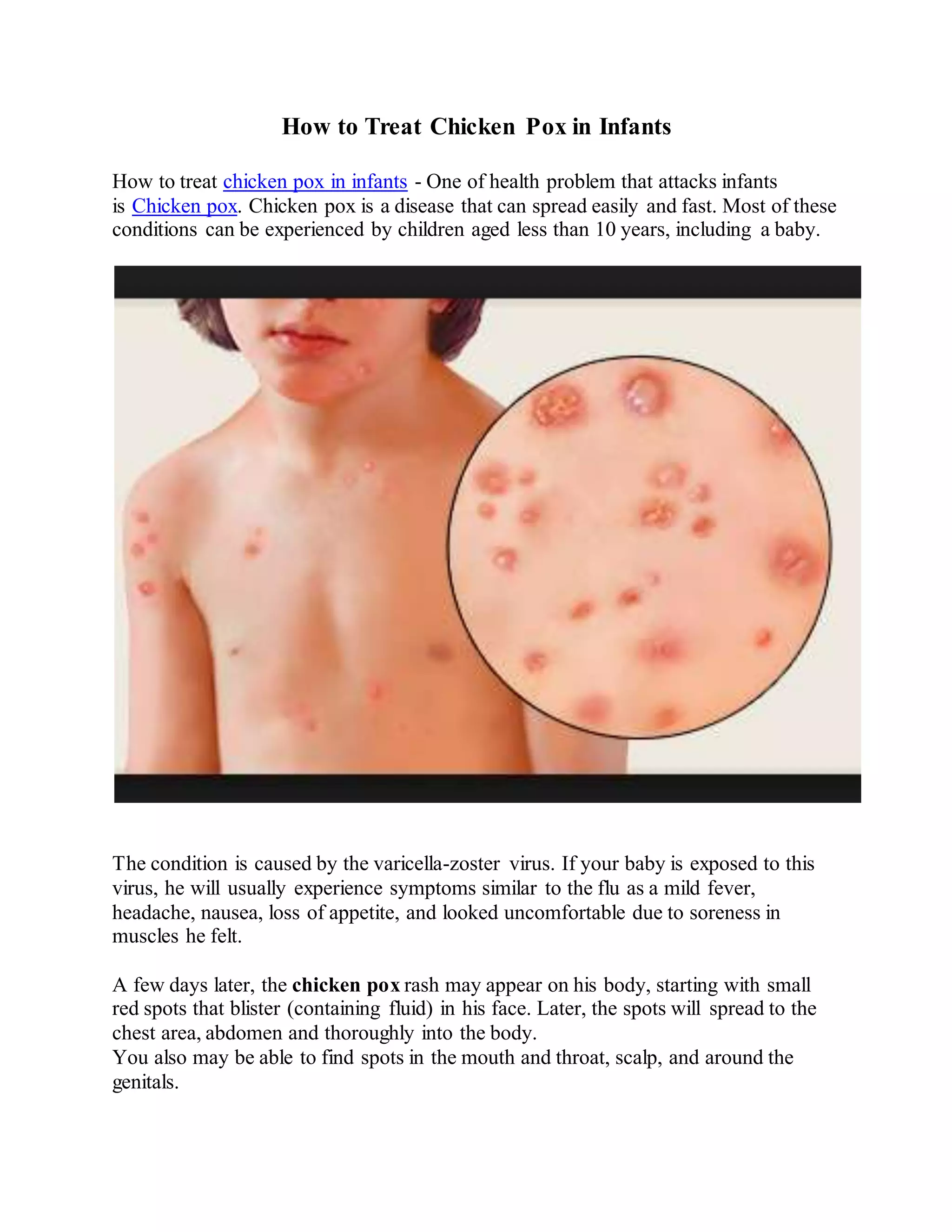 How to treat chicken pox in infants | PDF
