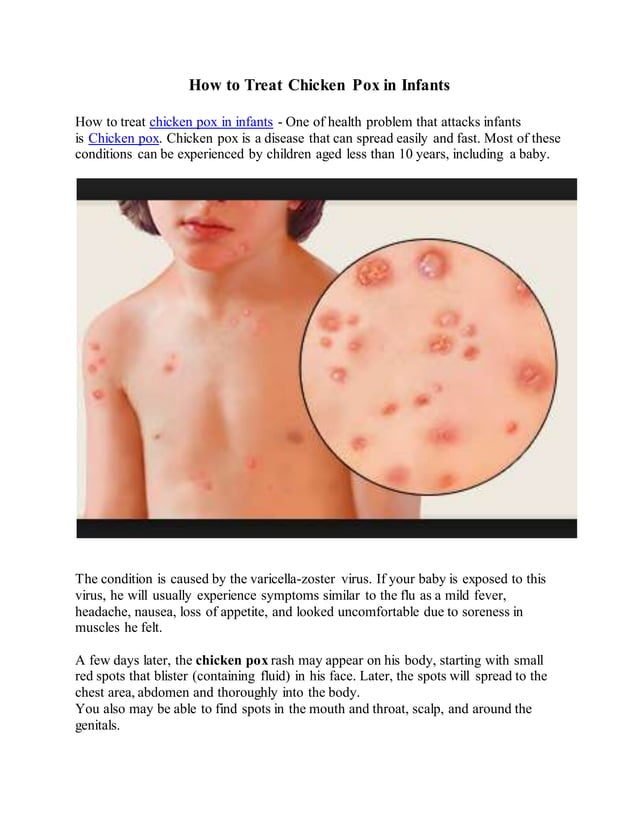How to treat chicken pox in infants | PDF