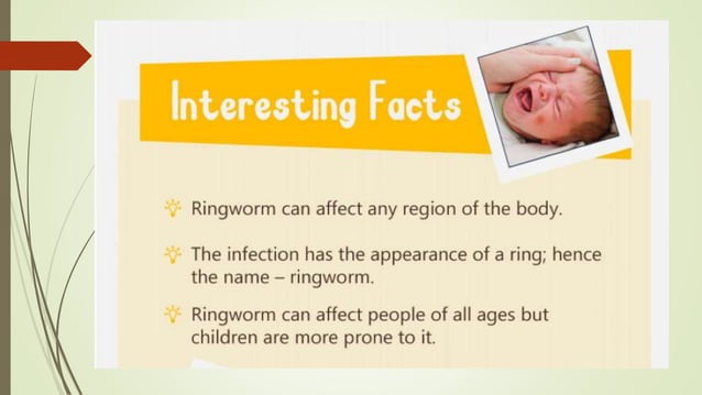 How to treat ringworm in babies - Curecity | PPT