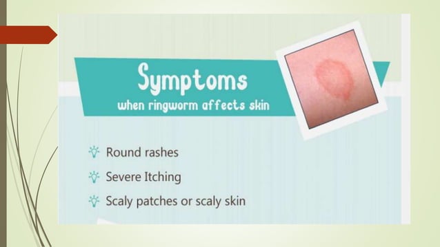 How to treat ringworm in babies - Curecity | PPT