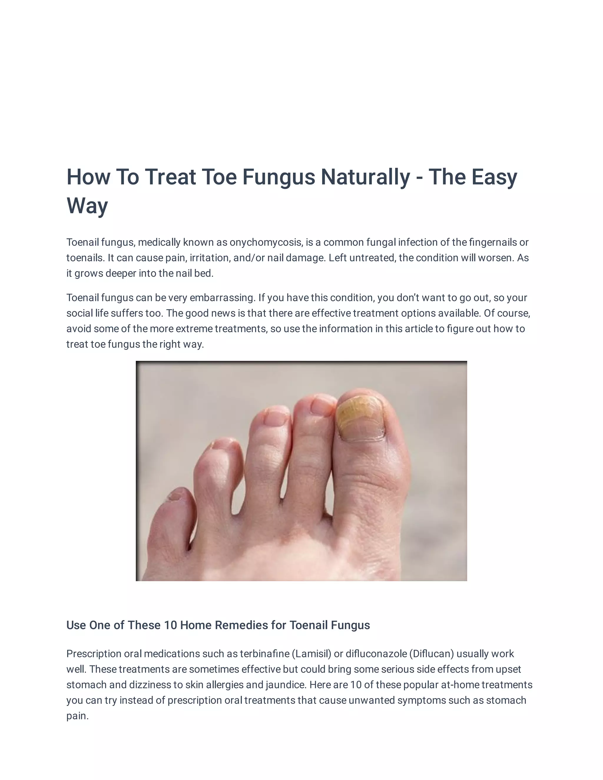 How To Treat Toe Fungus Naturally - The Easy Way | PDF | Nail Care | Beauty