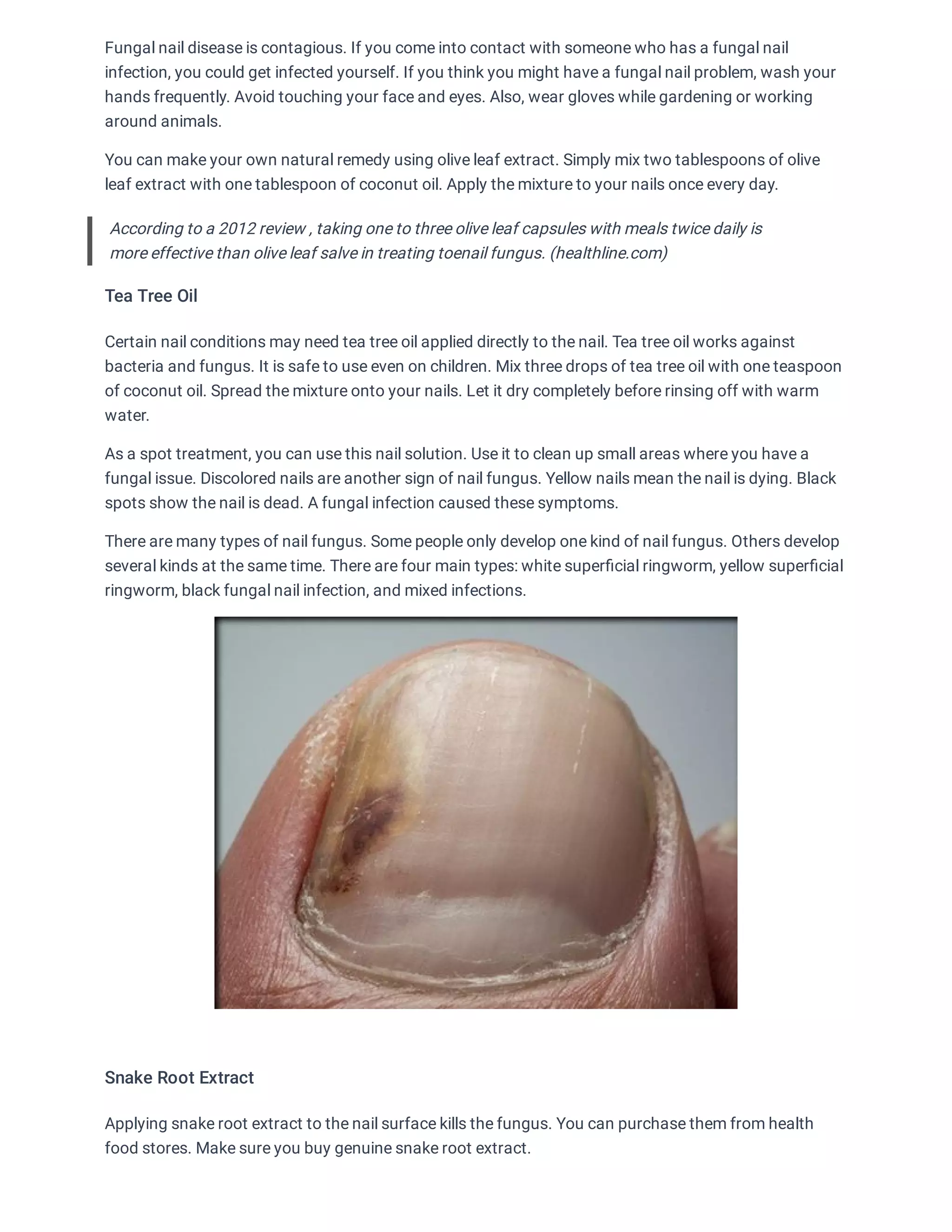 How To Treat Toe Fungus Naturally - The Easy Way | PDF