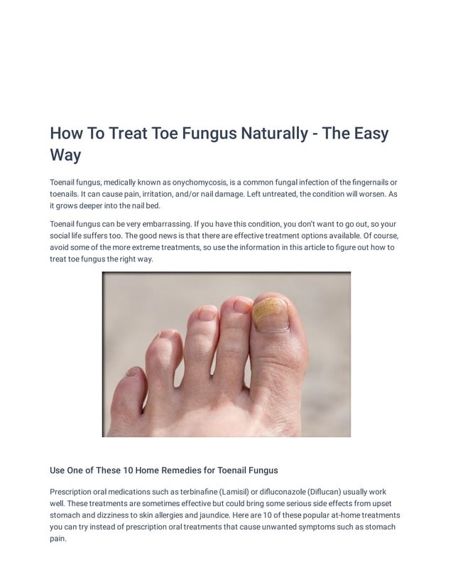 How To Treat Toe Fungus Naturally - The Easy Way | PDF | Nail Care | Beauty