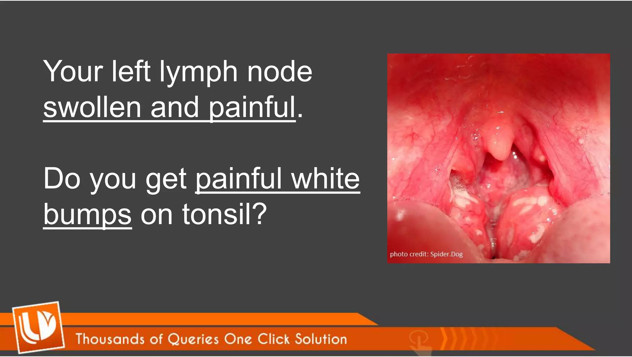 Solution: How to Treat White Pus on Tonsils? | PPTX