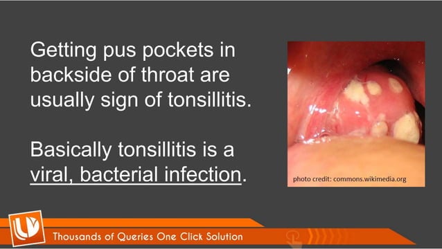 Solution: How to Treat White Pus on Tonsils? | PPTX