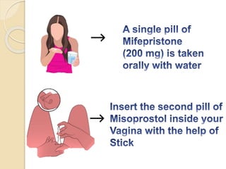 How to use misoprostol vaginally | PPTX | Pregnancy | Reproductive Health