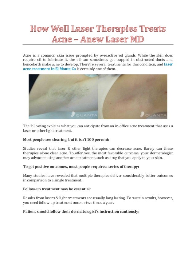 How Well Laser Therapies Treats Acne Anew Laser Md