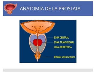 HPB. HIPERPLASIA PROSTATICA EN UROLOGIA PPT | PPTX