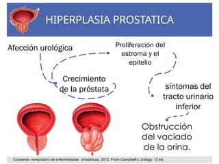 HPB. HIPERPLASIA PROSTATICA EN UROLOGIA PPT | PPTX