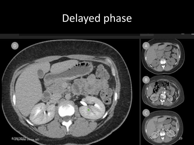 IMAGING IN HEPATOPANCREATICOBILIARY TUMORS - A GUIDE TO RT PLANNING | PPT