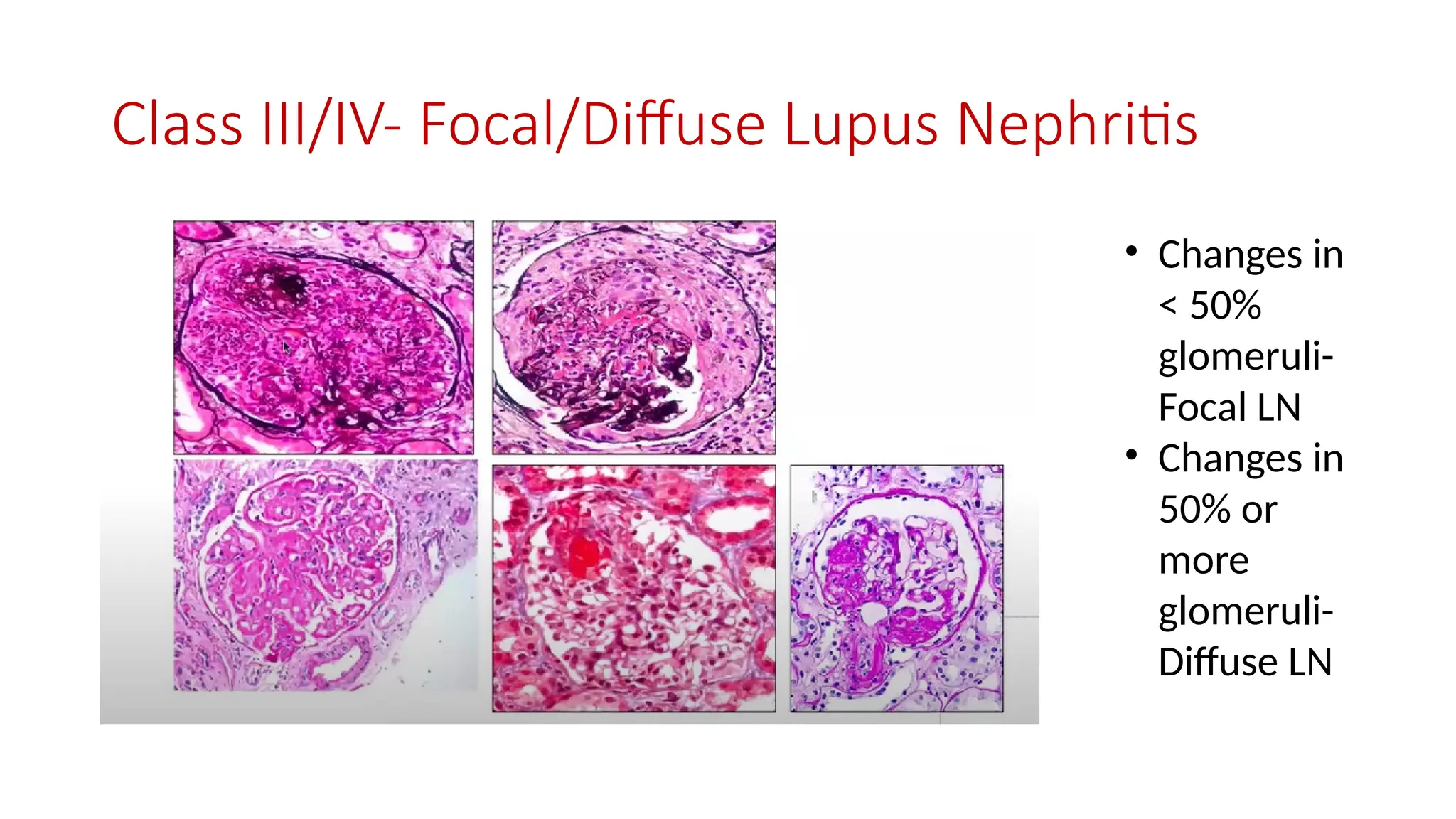 histopathology of classes of lupus nephritis | PPTX