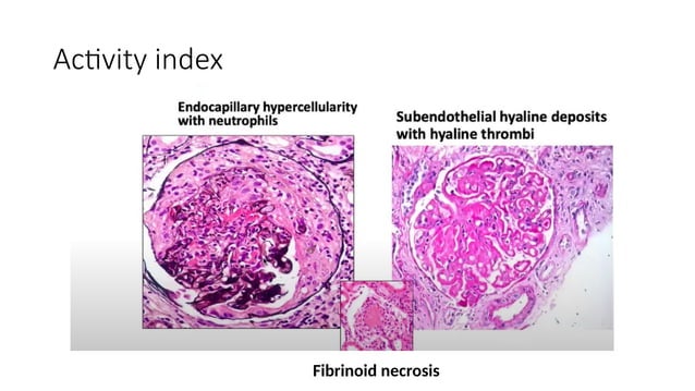 histopathology of classes of lupus nephritis | PPTX
