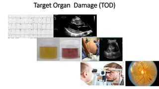 Hypertension in Athletes | PPT